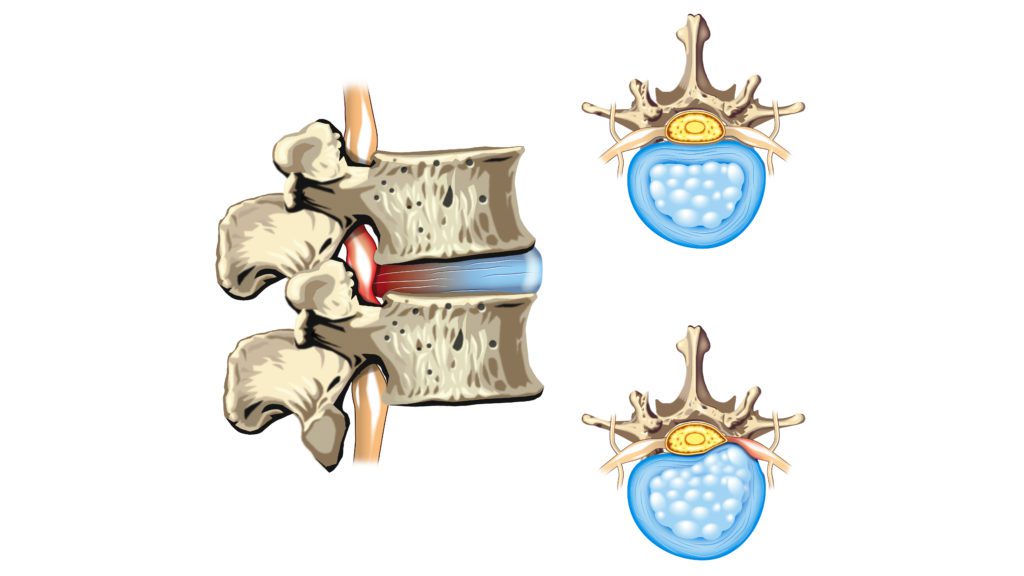 Intervertebral Disc Disease: Causes and Symptoms